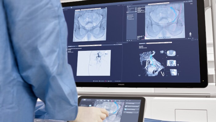 Prostate Artery Embolization (PAE) | Philips