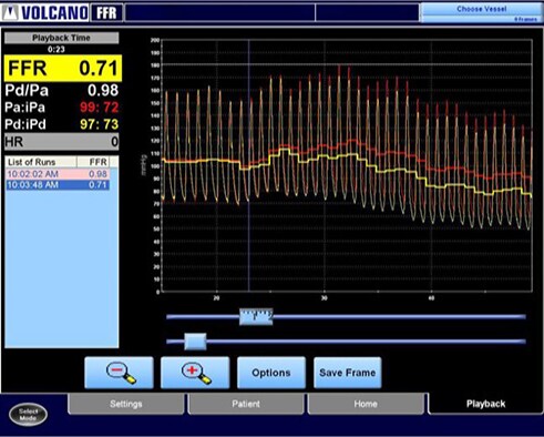 iFR and FFR help to guide PCI | Philips
